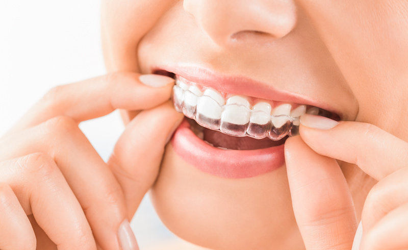How Digital Scanning Improves the Process for Invisalign