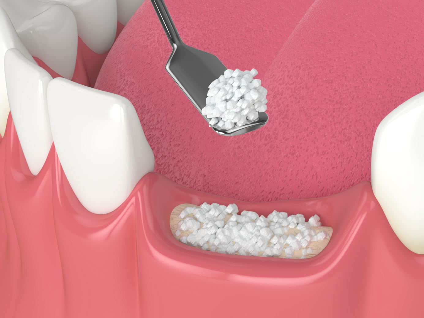 What to Expect During Dental Bone Graft Recovery